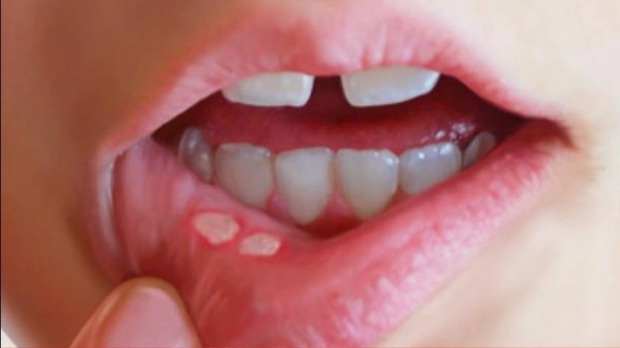 RTS :: Društvo :: Roditelji zabrinuti – šta je BRNU virus koji se ...